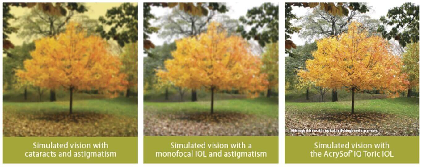 Cataract Surgery Utica | Cataracts New Hartford, NY | CNY Eye Physicians